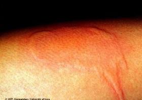 Lesions a la Pell :: Primers Auxilis Traumatismes